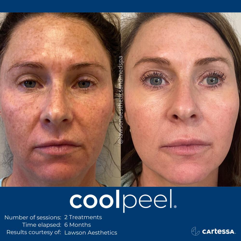 CoolPeel Laser Resurfacing Before After Inbloom Health Medispa CoolPeel Laser Resurfacing Before After Inbloom Health Medispa